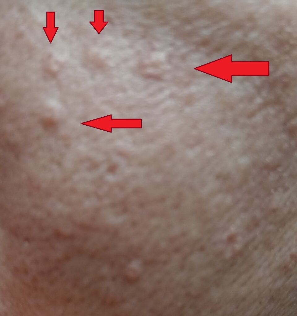 My Struggle with Sebaceous Hyperplasia